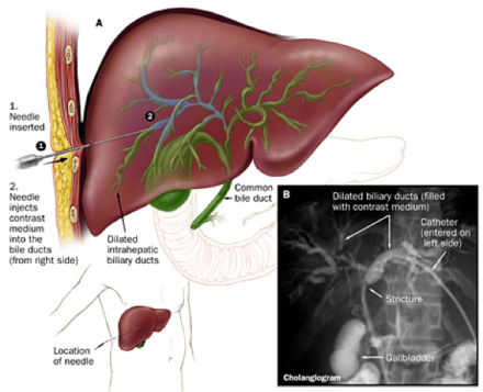 #21 – Acute Cholangitis | PAINE Podcast and Medical Blog