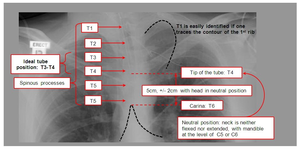 #23 – Essentials of Intubation | PAINE Podcast and Medical Blog