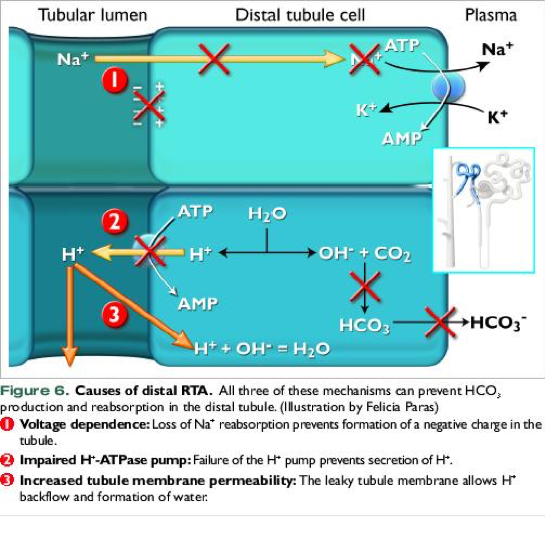 #51 – Renal Tubular Acidosis | PAINE Podcast and Medical Blog