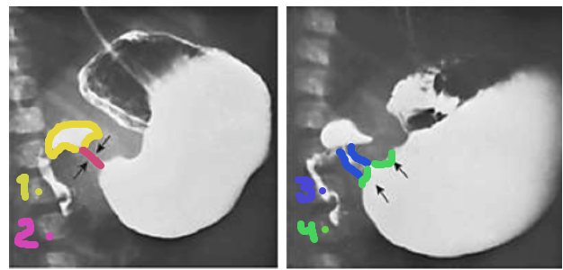 #52 – Pyloric Stenosis | PAINE Podcast and Medical Blog