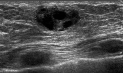 #69 – Benign Breast Diseases | PAINE Podcast and Medical Blog