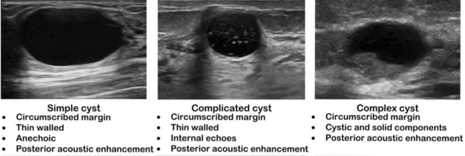 #69 – Benign Breast Diseases | PAINE Podcast and Medical Blog